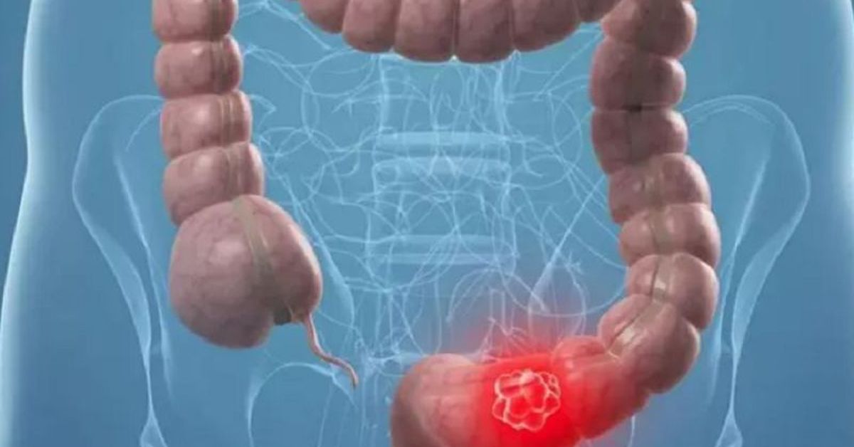 La Ciudad impulsa el cribado de cáncer colorrectal: SMS, recogida de ...